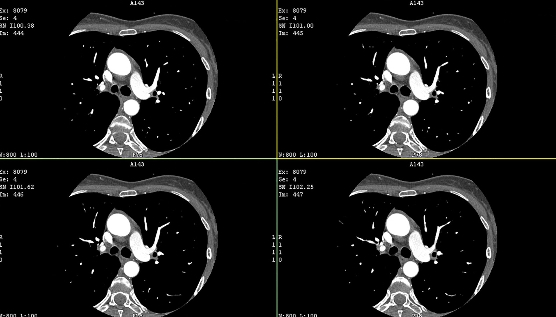 Enhancing Cardiac Imaging with 3D to Achieve Personalized Medicine at ...