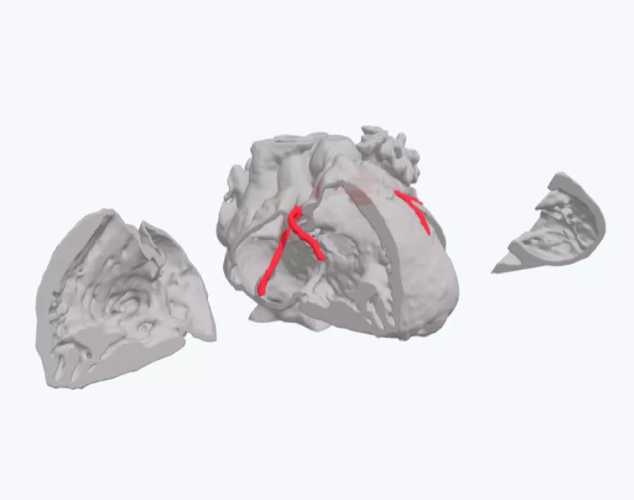 3D Printed Model Helps Clinical Team Plan Surgery for Infant with ...
