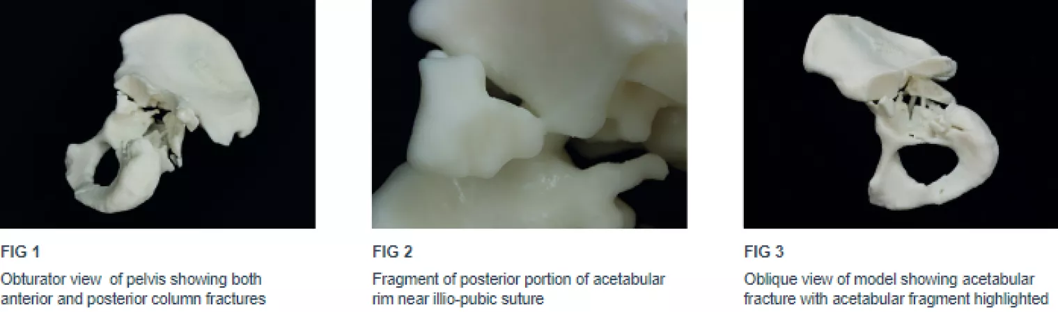 Enhancing Precision in Orthopaedic Trauma: A Case Study on Comminuted ...