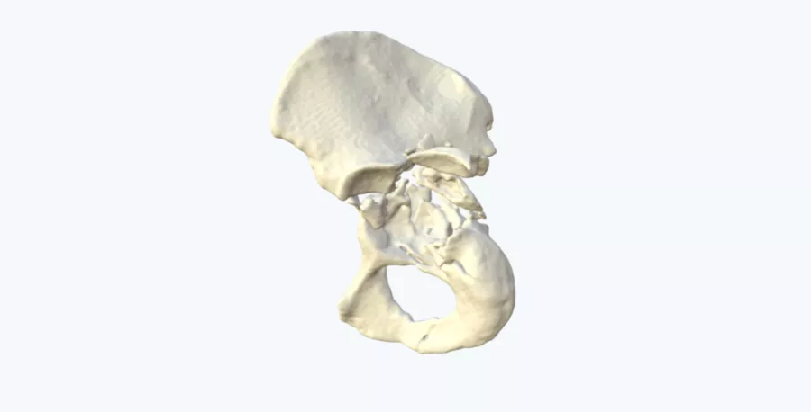 Enhancing Precision in Orthopaedic Trauma: A Case Study on Comminuted ...