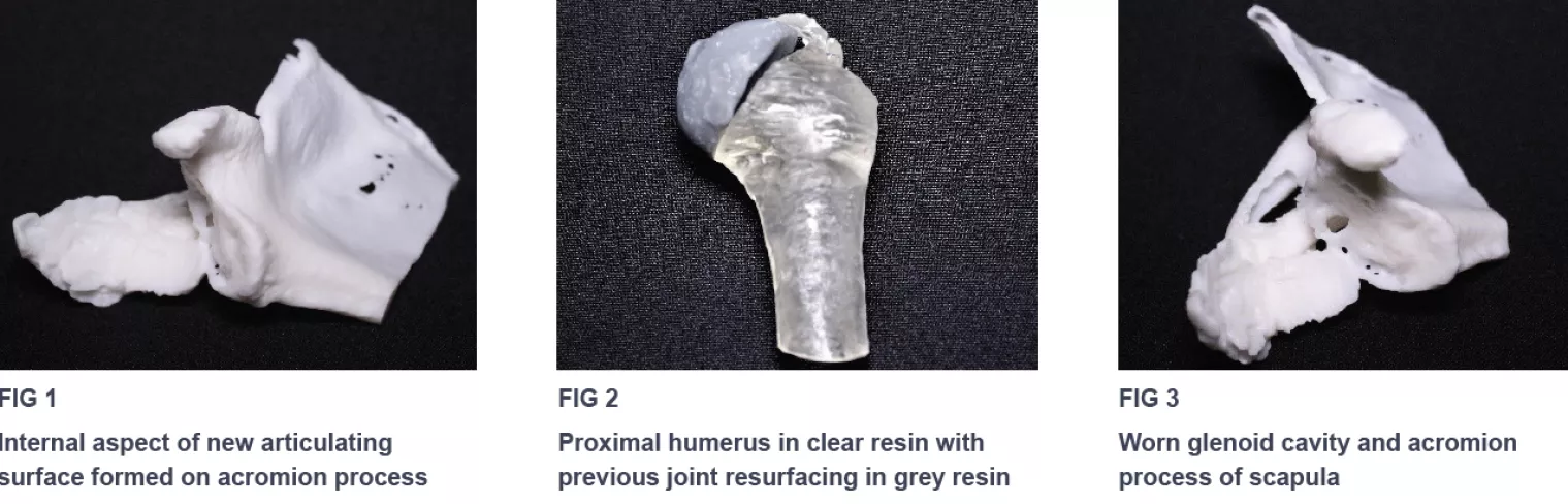 Reducing surgical time - glenoid cavity pathology - Axial3D