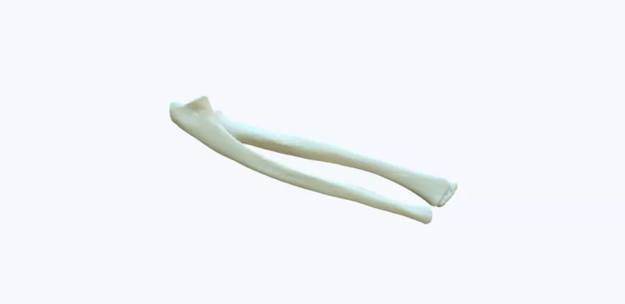 3D printed twisted radius and ulna model reduces surgery time by 3.5 ...