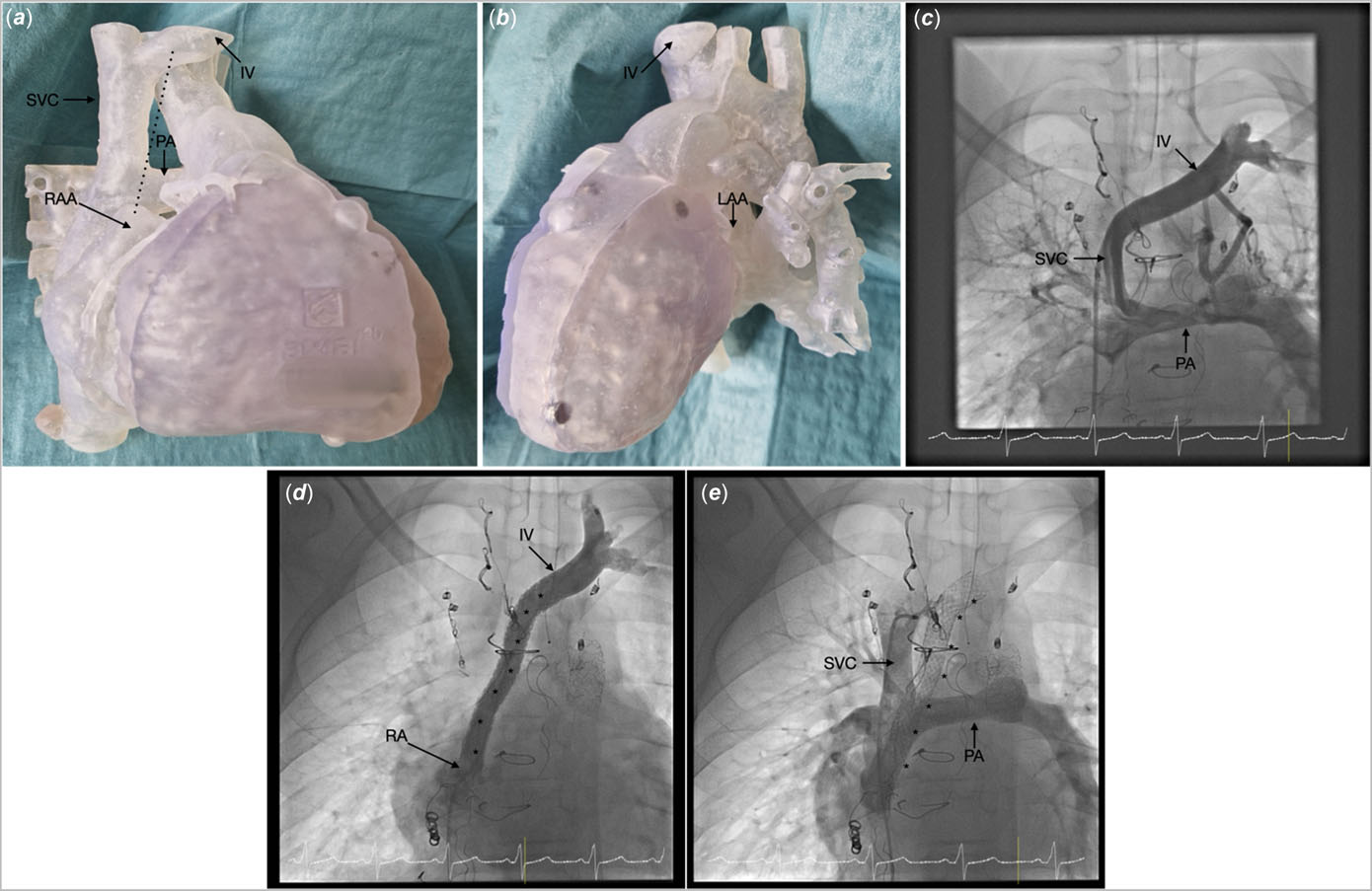 3D Printed Heart Models Guide Complex Innominate Vein Redirection ...