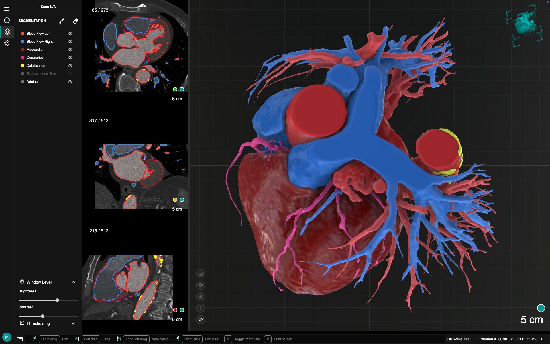NEW Cardiovascular Medical Device - Axial3D