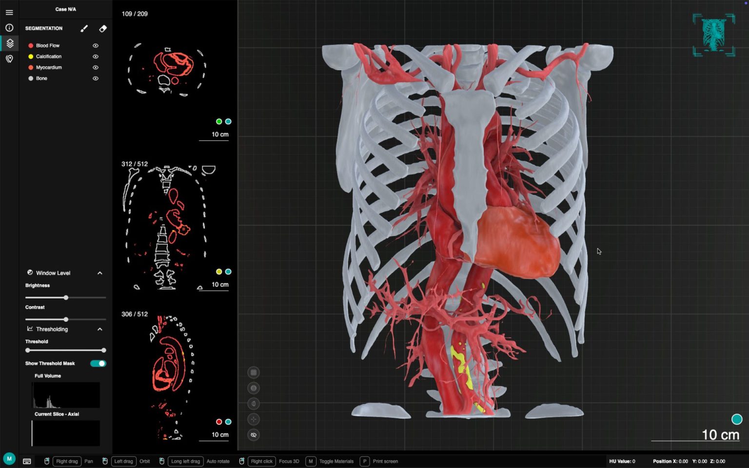 Cardiovascular - Axial3D