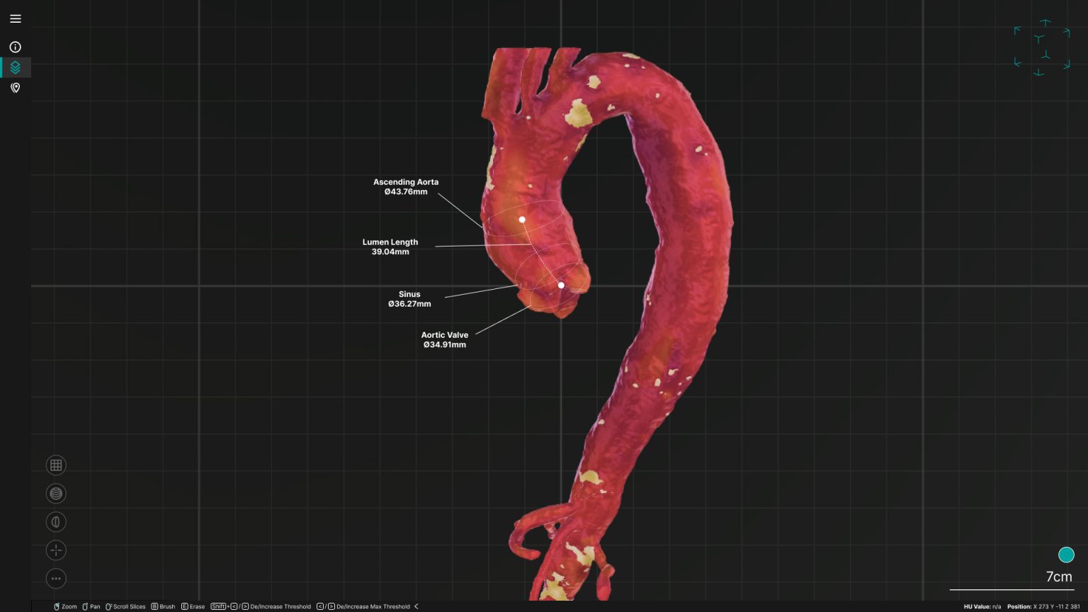 NEW Cardiovascular Medical Device - Axial3D